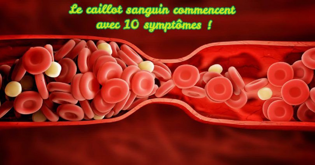 Le caillot sanguin commencent avec 10 symptômes