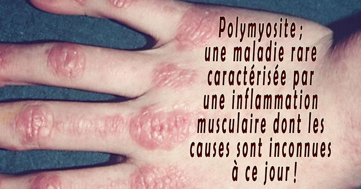 Polymyosite; une maladie rare caractérisée par une inflammation ...