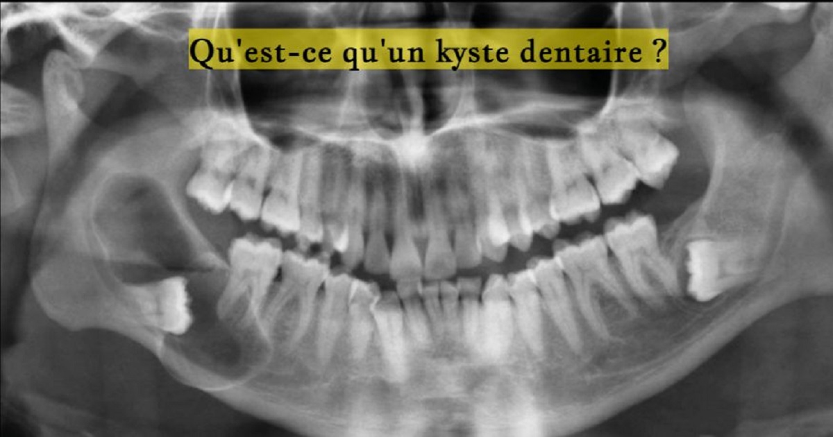 Qu'est-ce qu'un kyste dentaire