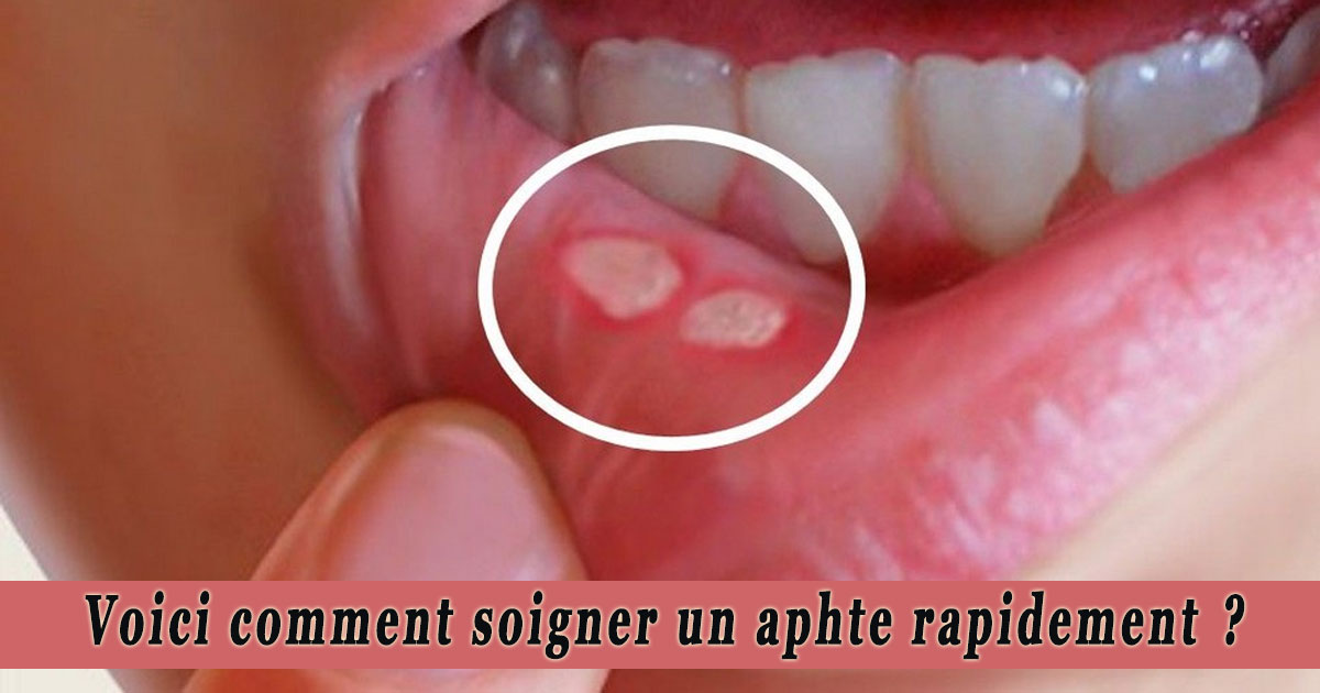Voici comment soigner un aphte rapidement